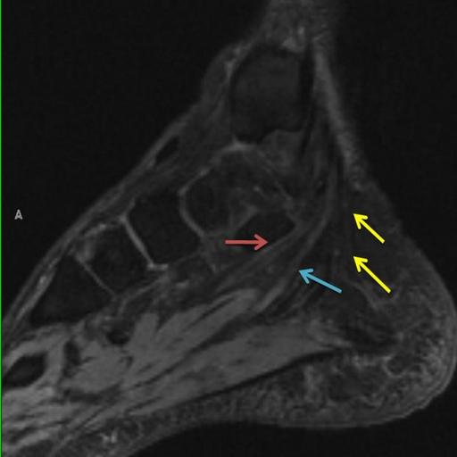 Tarsal Tunnel