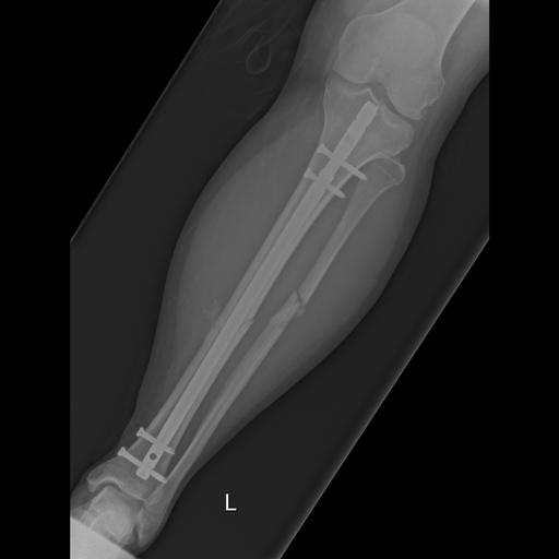 Mira wiD, Lower Leg, ap - Siemens Healthineers Indonesia