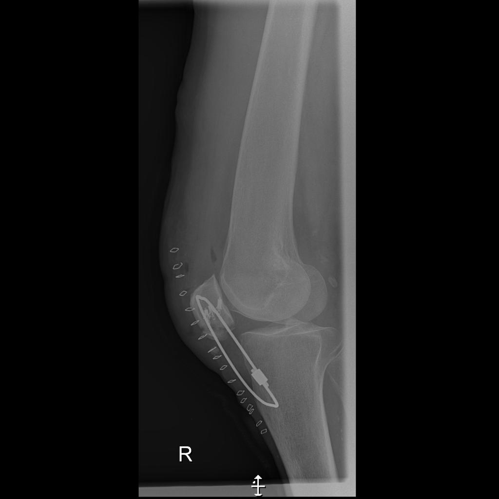 Mira wiD, Knee I, lateral retropatellar gap free - Siemens Healthineers ...