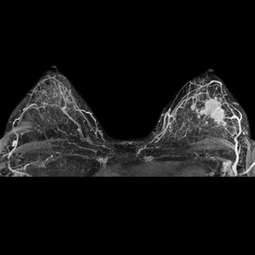16-Channel AI Breast Coil - Siemens Healthineers