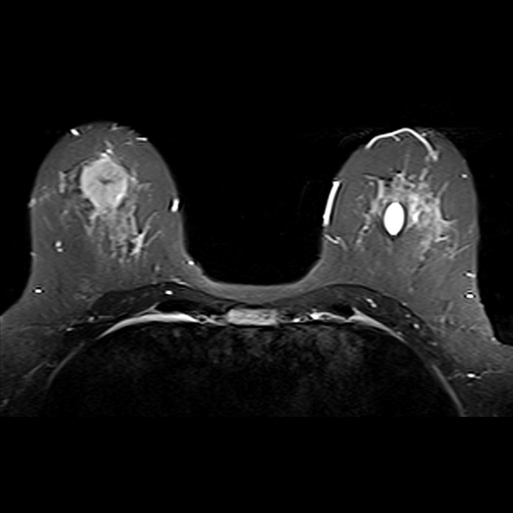 Sentinelle Breast Coil (2/4/8-channel) - Siemens Healthineers USA
