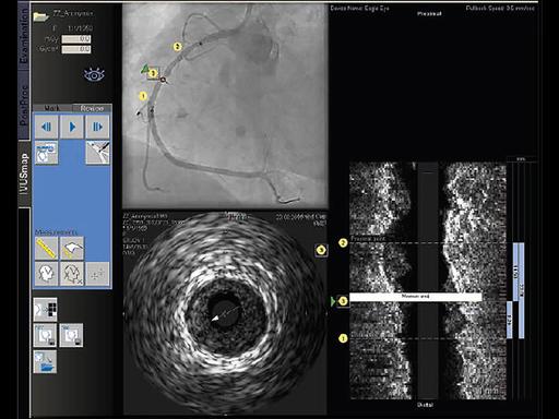 IVUSmap - Siemens Healthineers USA