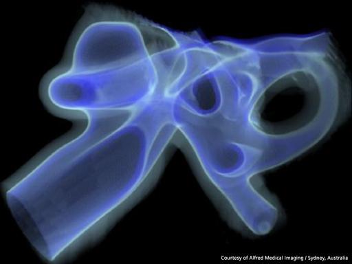 SOMATOM Emotion - Siemens Healthineers España