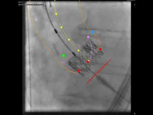 Cardiac Surgery