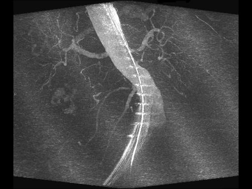 Vascular Surgery - Siemens Healthineers USA