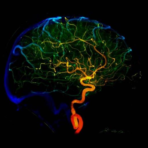 Radiología de Intervención para Apoplejía Isquémica - Siemens ...
