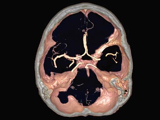 CT Neuro Engine - Siemens Healthineers USA