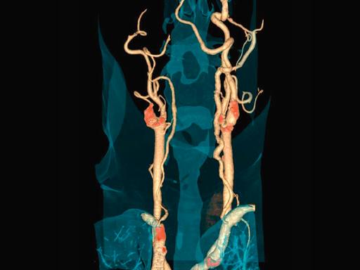 Neurology - Siemens Healthineers