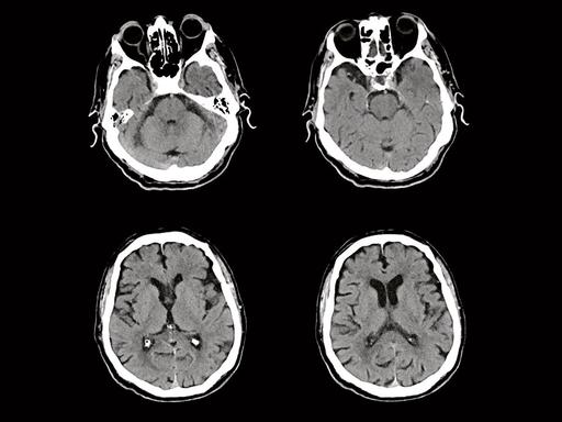 SOMATOM Perspective CT Scanner - Siemens Healthineers