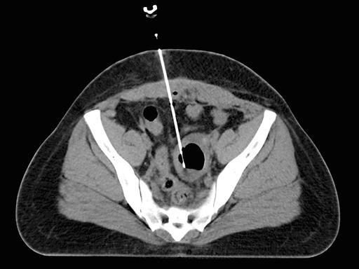 CT-guided therapy - Siemens Healthineers España