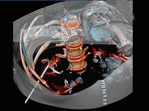 CT-guided therapy - Siemens Healthineers España
