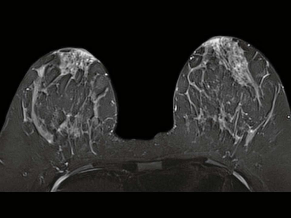 Breast MRI - Siemens Healthineers