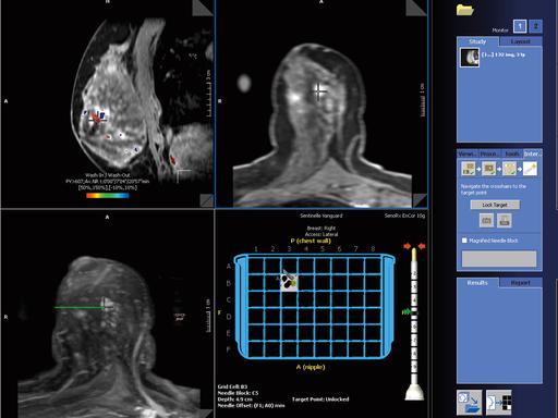 Breast MRI - Siemens Healthineers USA