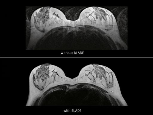 Breast MRI - Siemens Healthineers USA