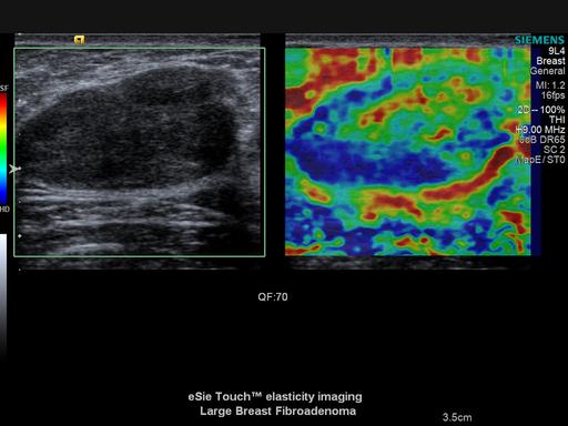Breast Imaging with Ultrasound & Mammography. - Siemens Healthineers USA