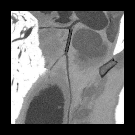 SOMATOM Definition Flash - CT Scanner - Siemens Healthineers Vietnam