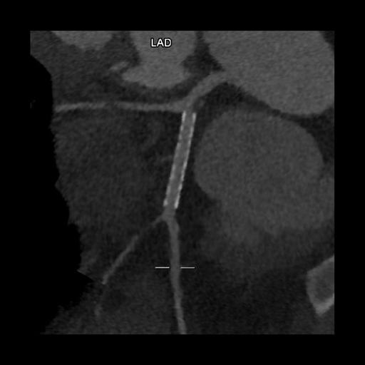 SOMATOM Definition Flash - CT Scanner - Siemens Healthineers Vietnam