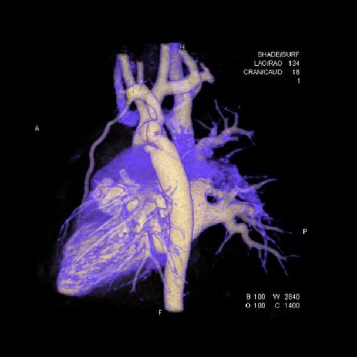 SOMATOM Definition Flash - CT Scanner - Siemens Healthineers Vietnam