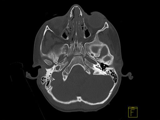 CT Scanner SOMATOM Scope