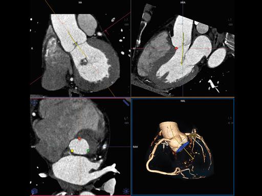 CT Cardio-Vascular Engine - Siemens Healthineers España