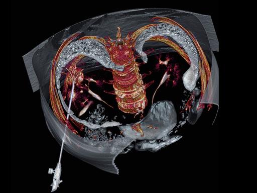 CT-guided therapy - Siemens Healthineers España