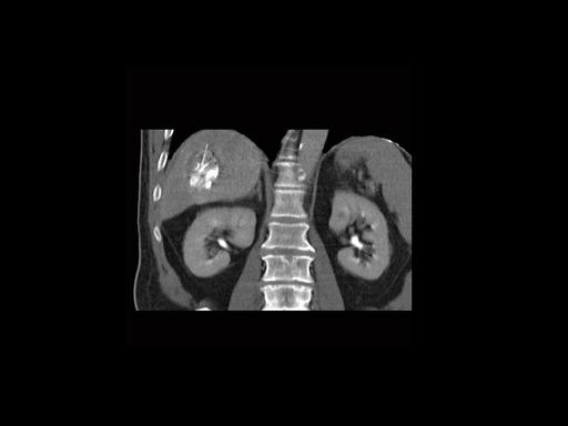 Terapia guiada por CT - Siemens Healthineers Latinoamérica