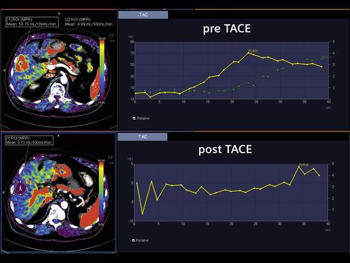 CT Oncology Engine - Siemens Healthineers USA