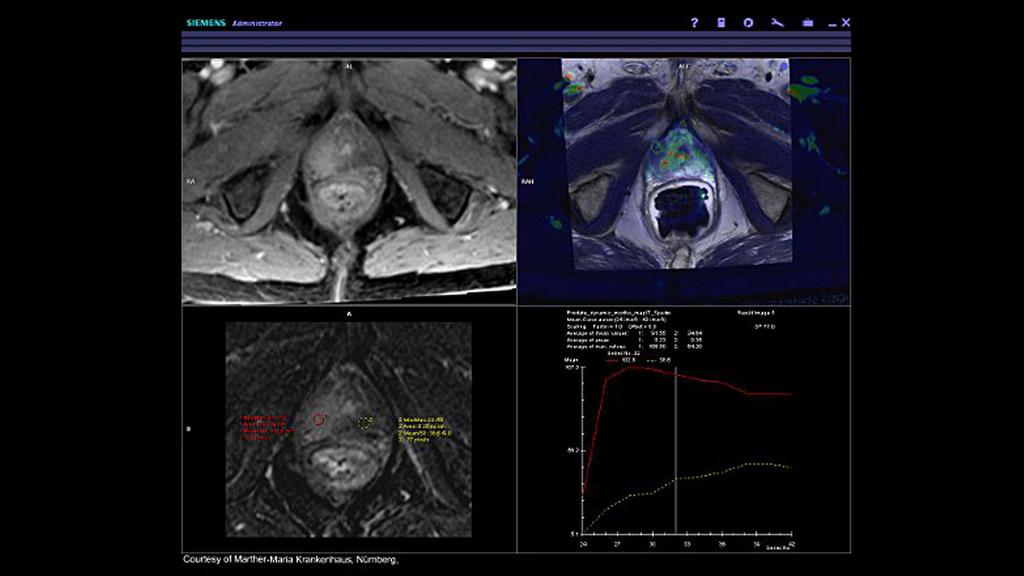 Prostate MRI - Siemens Healthineers USA