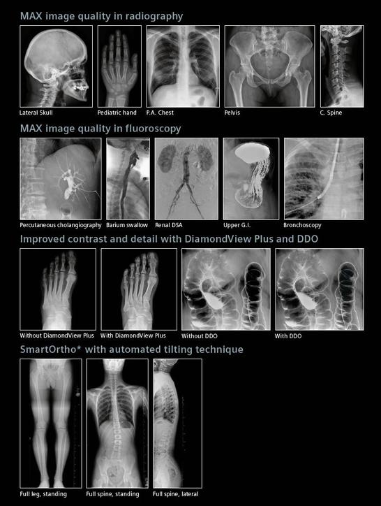 Approaches to Dose Reduction in Radiography and Fluoroscopy - Siemens ...