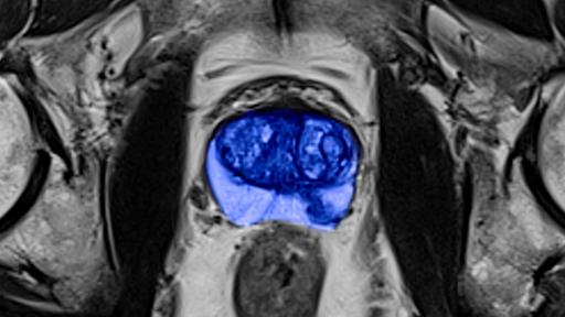 MR Prostate – AI-based segmentation and classification