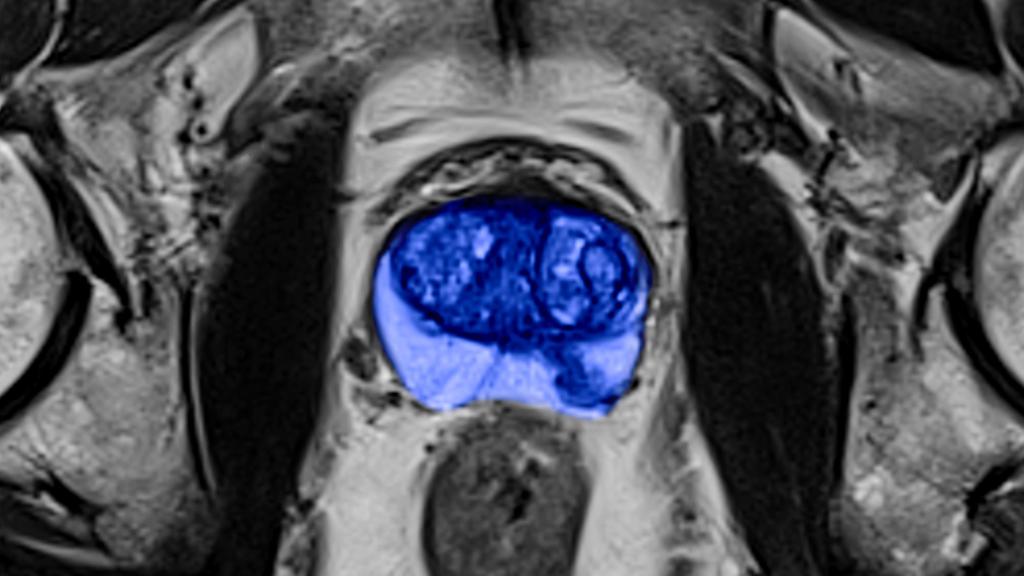 MR Prostate – AI-based segmentation and classification