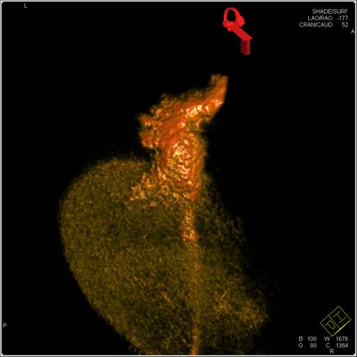 syngo DynaCT Cardiac - Siemens Healthineers USA
