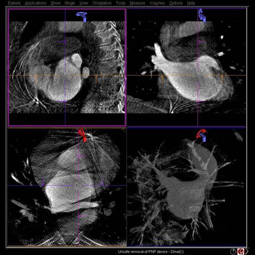 syngo DynaCT Cardiac