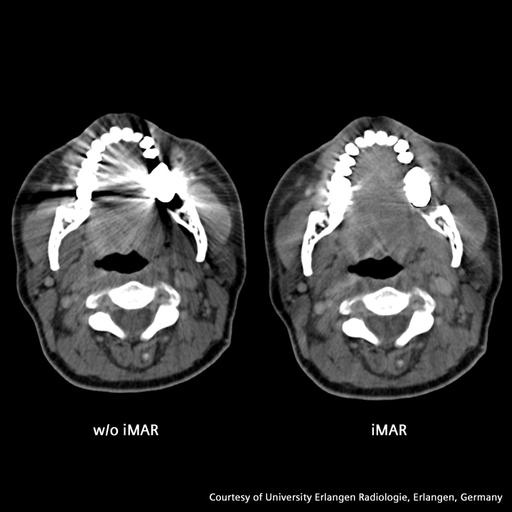 iMAR - Siemens Healthineers