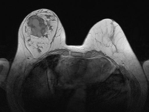 Breast MRI