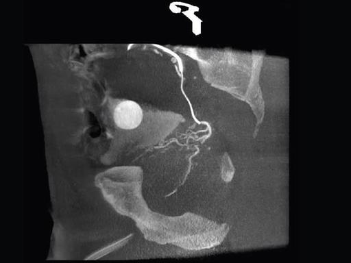 Peripheral and Vascular Interventions - Siemens Healthineers