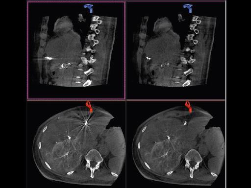 Peripheral and Vascular Interventions - Siemens Healthineers