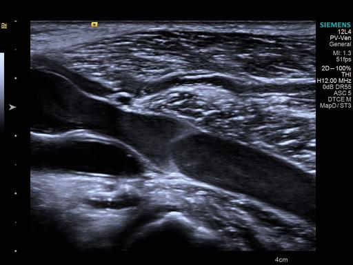 ACUSON S3000 Ultrasound System, HELX Evolution with Touch Control ...