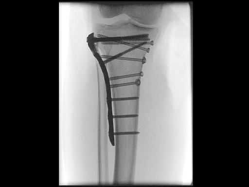 Mobile C-arm machine - Cios Fusion - Siemens Healthineers