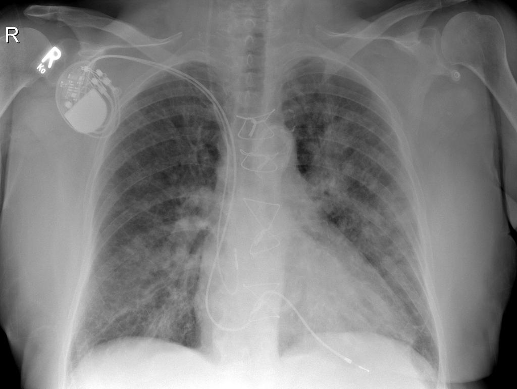 Mobilett Mira Max Chest IV lying a.p.