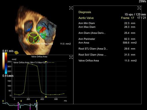 Advancing 3D TEE - Siemens Healthineers USA