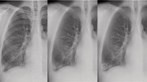 Diagnosis and treatment of lung cancer