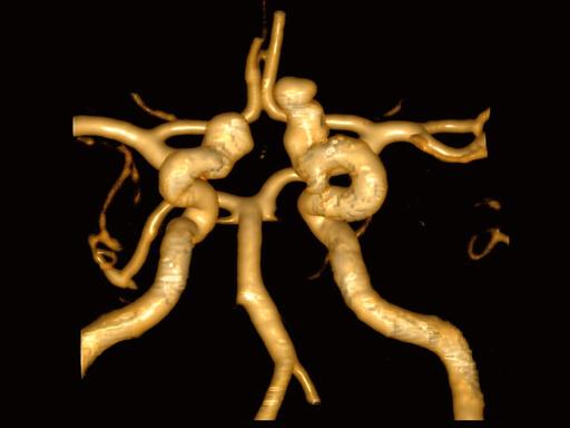 Пакет приложений для диагностики в неврологии - Siemens Healthineers Russia