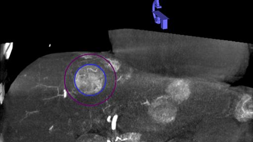 syngo Embolization Guidance - Siemens Healthineers