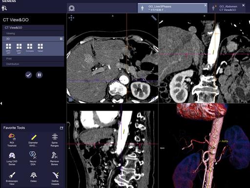 SOMATOM go.Now 지멘스 헬시니어스㈜