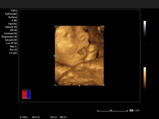 ACUSON NX2 Series Ultrasound System - Siemens Healthineers