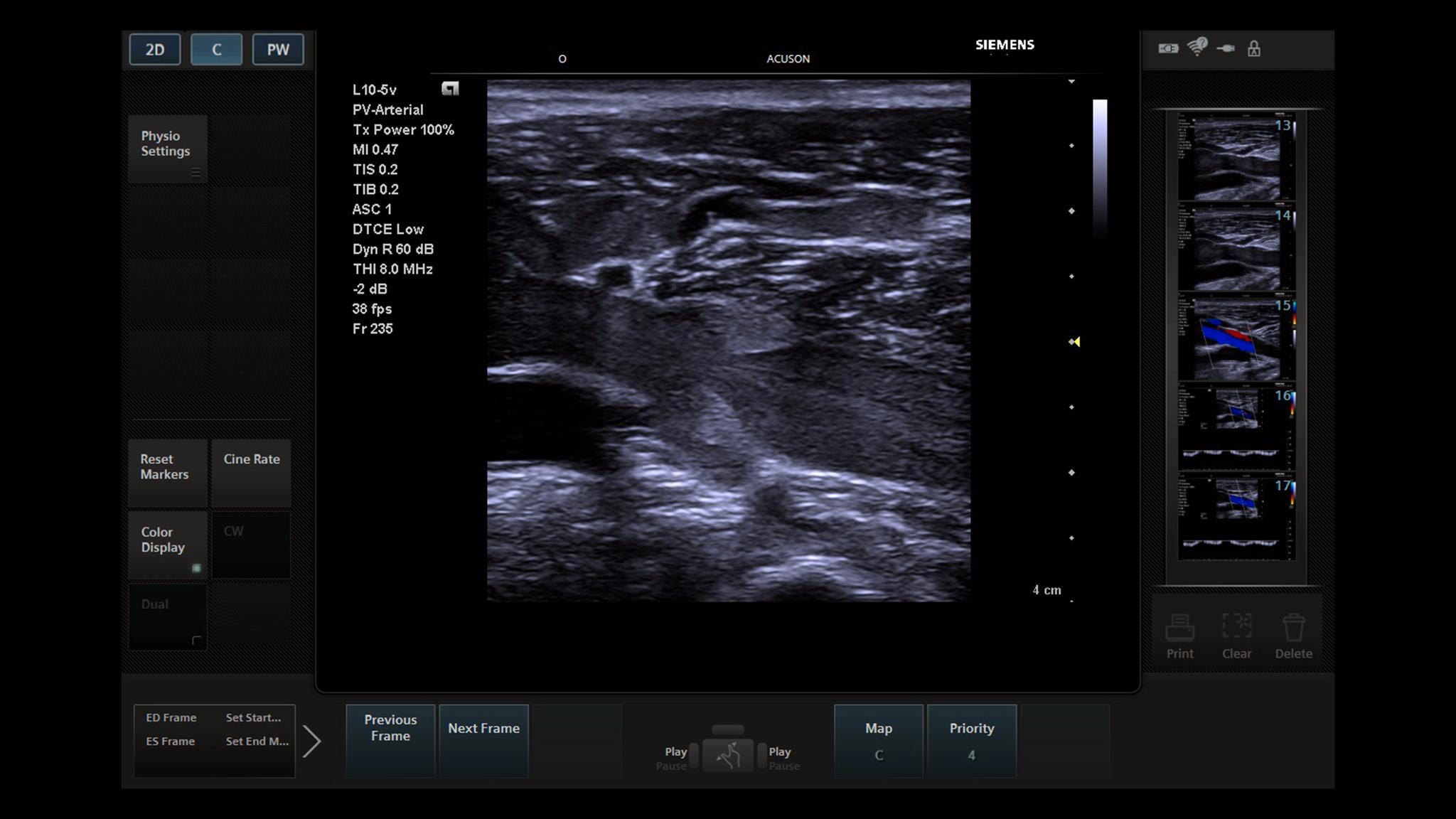 ACUSON P500 Ultrasound System