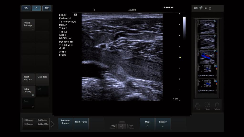 ACUSON P500 Ultrasound System - Siemens Healthineers