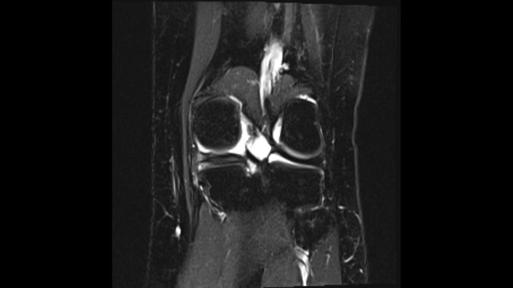 Tx/Rx Knee 15 Flare Coil