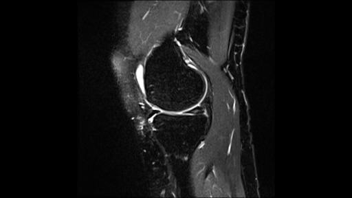 Tx/Rx Knee 15 Flare Coil - Siemens Healthineers